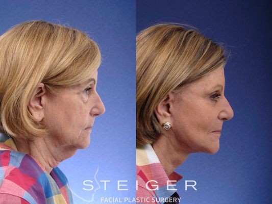 STEIGER FACIAL PLASTIC SURGERY: DR. JACOB D. STEIGER - Updated December ...