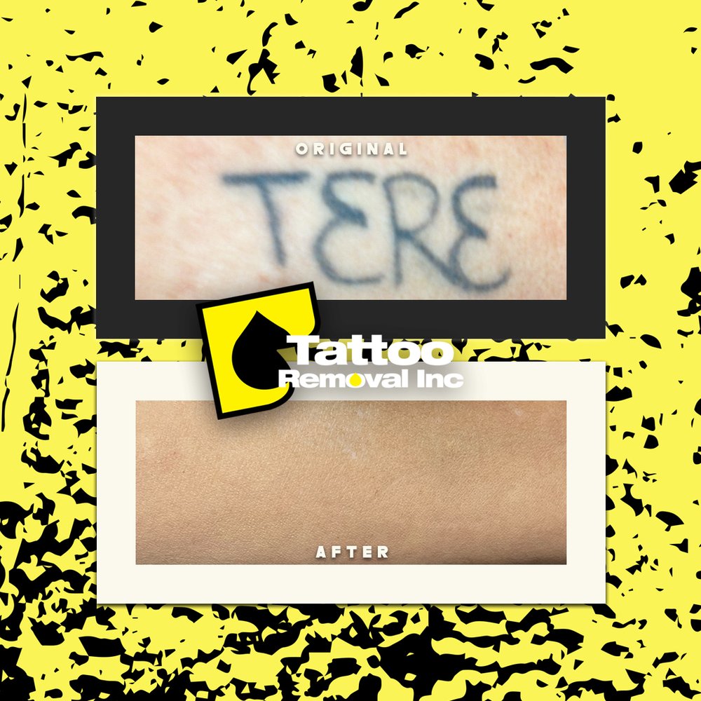 TATTOO REMOVAL - Updated July 2024 - 104 Photos & 65 Reviews - 5580 ...