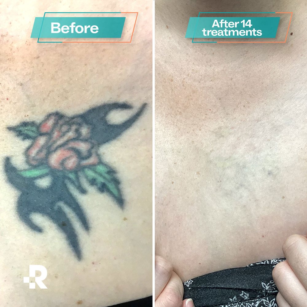 REMOVERY TATTOO REMOVAL & FADING - Updated May 2025 - 38 Photos - 4562 ...