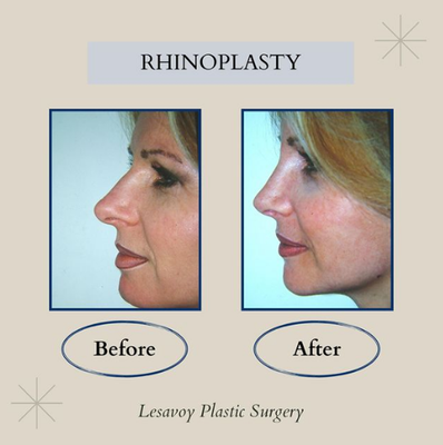 LESAVOY PLASTIC SURGERY - Updated July 2025 - 19 Photos - 9301 Wilshire ...