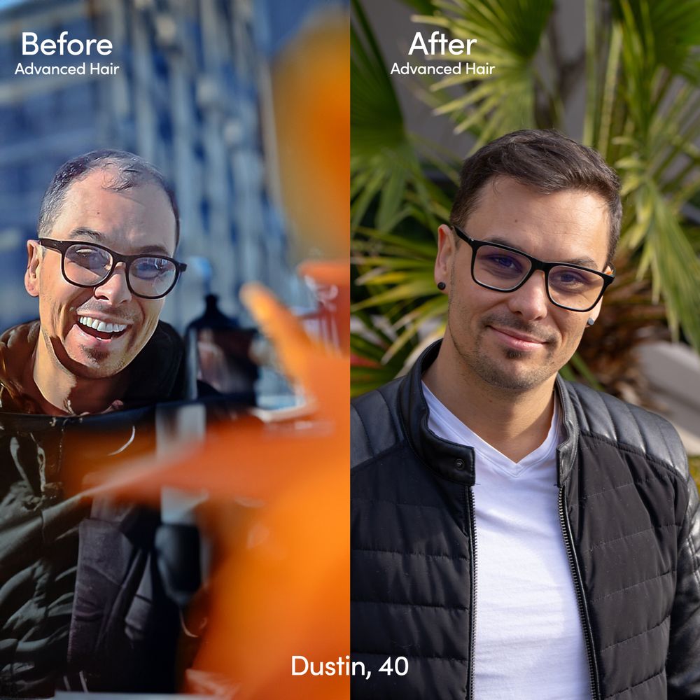 ADVANCED HAIR RESTORATION - 38 Photos & 35 Reviews - 9301 Wilshire Blvd ...