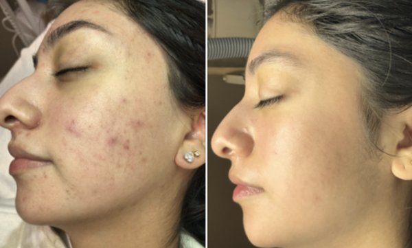 HOUSTON ACNE SPECIALISTS - Updated October 2025 - 77 Photos & 46 ...
