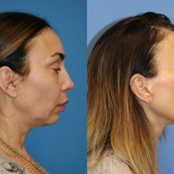 EVAN RANSOM, MD - 123 Photos & 171 Reviews - Cosmetic Surgeons - 450 ...