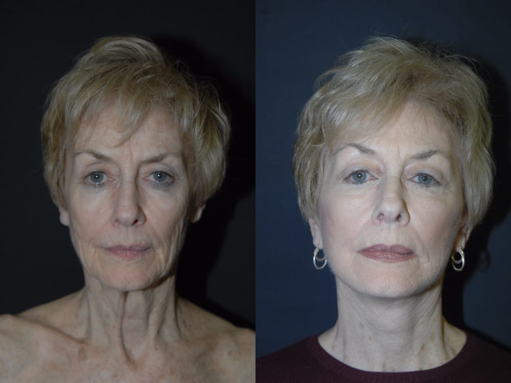 LORNE K ROSENFIELD, MD - PENINSULA PLASTIC SURGERY - Updated August ...