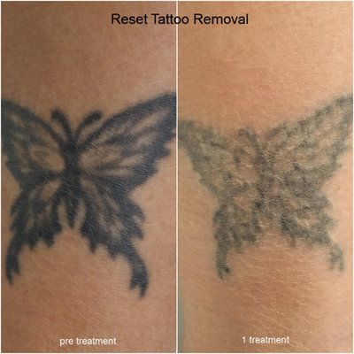 RESET TATTOO REMOVAL - Updated December 2025 - 110 Photos & 87 Reviews ...