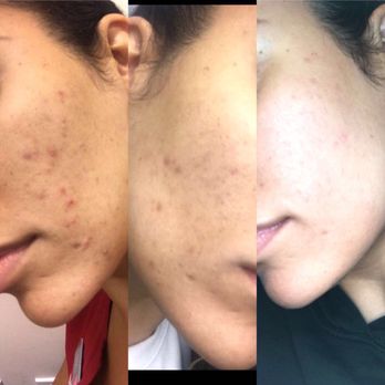 ACNE CLINIC NYC - Updated September 2025 - 99 Photos & 57 Reviews - 501 ...