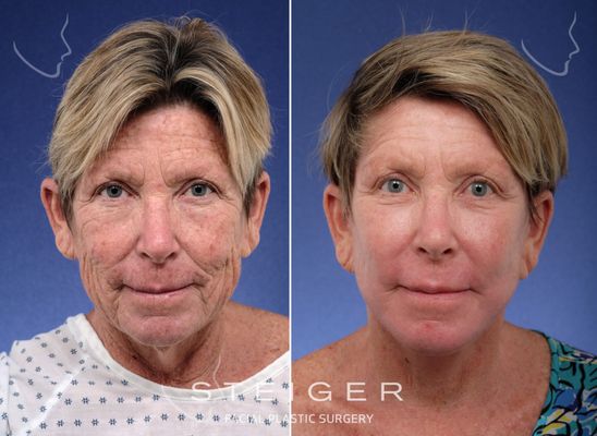 STEIGER FACIAL PLASTIC SURGERY: DR. JACOB D. STEIGER - Updated December ...