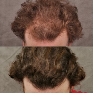 ADVANCED HAIR RESTORATION - 32 Photos & 16 Reviews - Hair Loss Centers ...