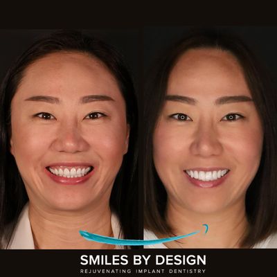 SMILES BY DESIGN - REJUVENATING IMPLANT DENTISTRY - Updated May 2026 ...