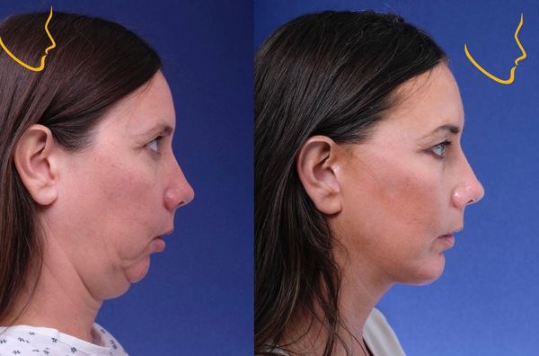 STEIGER FACIAL PLASTIC SURGERY: DR. JACOB D. STEIGER - Updated December ...