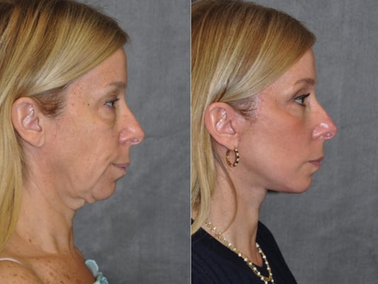 BEN TALEI, MD - 205 Photos & 180 Reviews - Cosmetic Surgeons - 465 N ...
