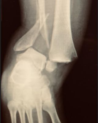 DR. RYAN M SHERICK- APEX FOOT AND ANKLE INSTITUTE - Updated January ...