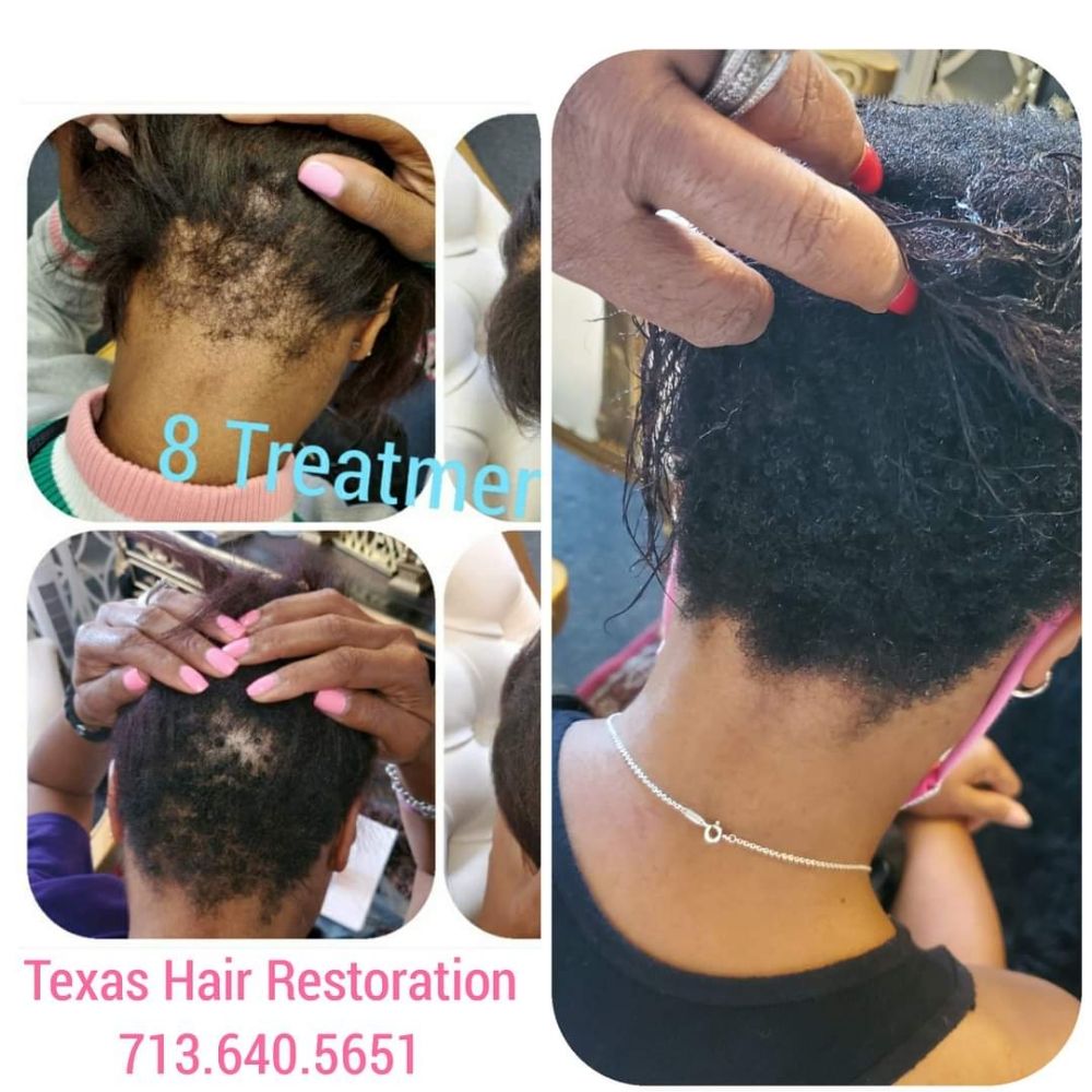 TEXAS HAIR RESTORATION AND WELLNESS CENTER - 44 Photos & 13 Reviews ...