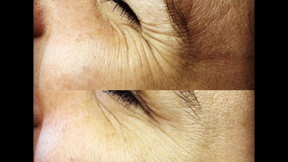 ELLE AESTHETICS - Request an Appointment - 1485 S Colorado Blvd, Denver ...