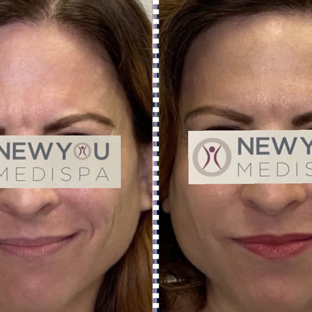 Top 10 Best Botox in Freehold Township, NJ - Last Updated August 2021 ...