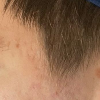 MOLE REMOVAL LOS ANGELES - Updated May 2026 - 20 Photos & 11 Reviews ...