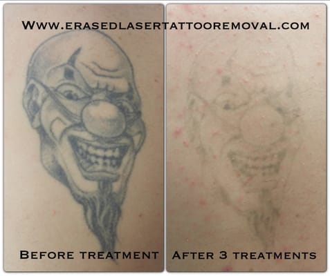 ERASED LASER TATTOO REMOVAL - Updated April 2026 - 71 Photos & 85 ...