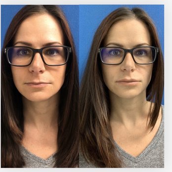 JOSEPH J HIRSCHFELD MD - BAY AREA COSMETIC SURGICAL CENTER - Updated ...