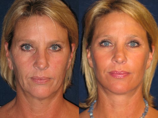 MILLER COSMETIC SURGERY CENTER - SCOTT R. MILLER, MD, FACS - Updated ... MILLER COSMETIC SURGERY CENTER - SCOTT R. MILLER, MD, FACS - Updated ...