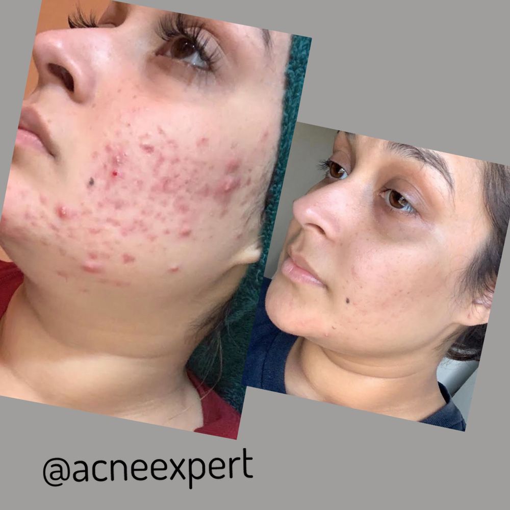 ACNE EXPERT SKINCARE - Updated June 2024 - 52 Photos & 47 Reviews - 415 ...