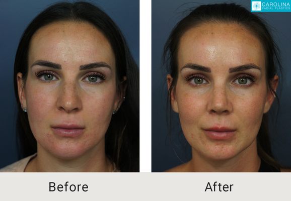 CAROLINA FACIAL PLASTICS - Updated March 2025 - 387 Photos & 35 Reviews ...