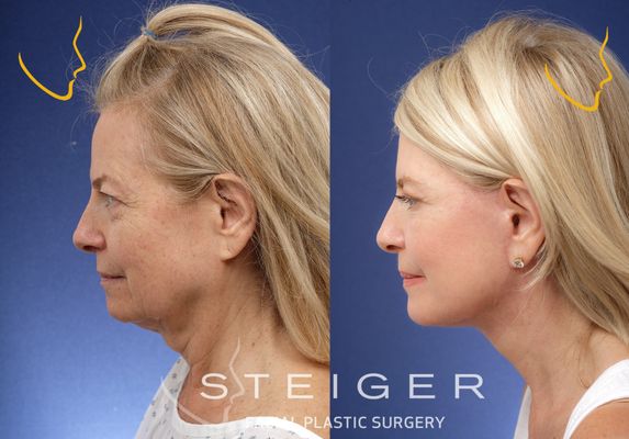 STEIGER FACIAL PLASTIC SURGERY: DR. JACOB D. STEIGER - Updated December ...