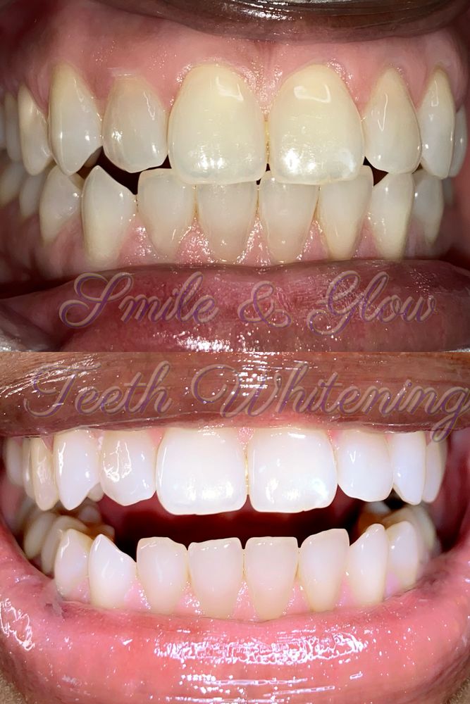 SMILE AND GLOW TEETH WHITENING - Updated December 2025 - 26 Photos ...