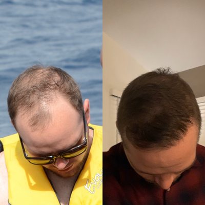 ADVANCED HAIR RESTORATION with 34 Reviews & 32 Photos - 9301 Wilshire ...