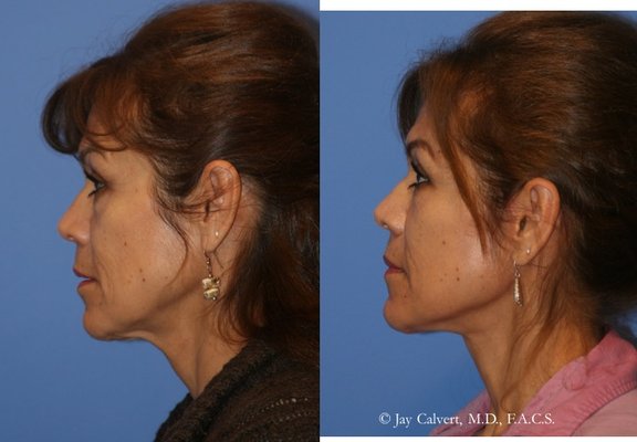 DR JAY CALVERT PLASTIC SURGERY - Updated December 2025 - 39 Photos & 34 ...