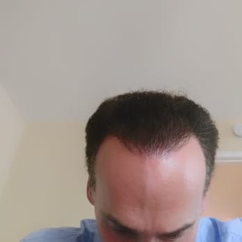 ADVANCED HAIR RESTORATION - 35 Photos & 22 Reviews - 11040 Main St ...