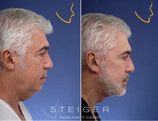 STEIGER FACIAL PLASTIC SURGERY: DR. JACOB D. STEIGER - Updated December ...