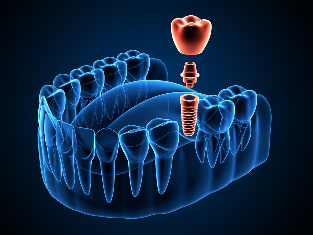 NOVA PERIODONTICS & DENTAL IMPLANTS - Updated December 2025 - 3166 ...