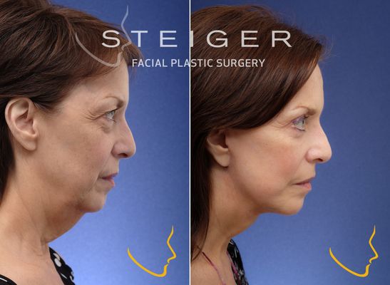 STEIGER FACIAL PLASTIC SURGERY: DR. JACOB D. STEIGER - Updated December ...