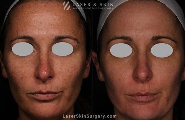 LASER & SKIN SURGERY CENTER OF NEW YORK - Updated December 2025 - 156 ...