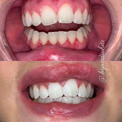 B’YOND WHITE COSMETIC TEETH WHITENING - Updated January 2025 - Request ...