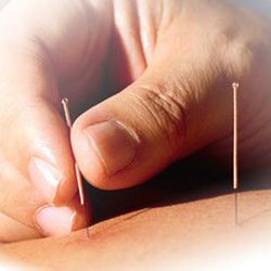 Best Acupuncture Near Me - December 2025: Find Nearby Acupuncture ...