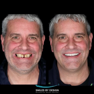 SMILES BY DESIGN - REJUVENATING IMPLANT DENTISTRY - 48 Photos & 10 ...