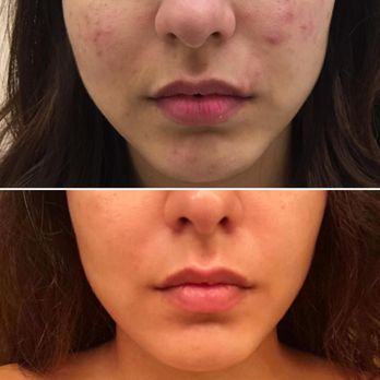 ACNE CLINIC NYC - Updated September 2025 - 99 Photos & 57 Reviews - 501 ...