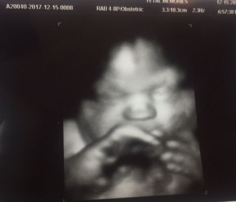 FETAL MEMORIES 2D 3D 4D ULTRASOUND - Updated September 2025 - 151 ...