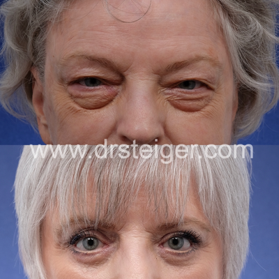 STEIGER FACIAL PLASTIC SURGERY: DR. JACOB D. STEIGER - Updated December ...