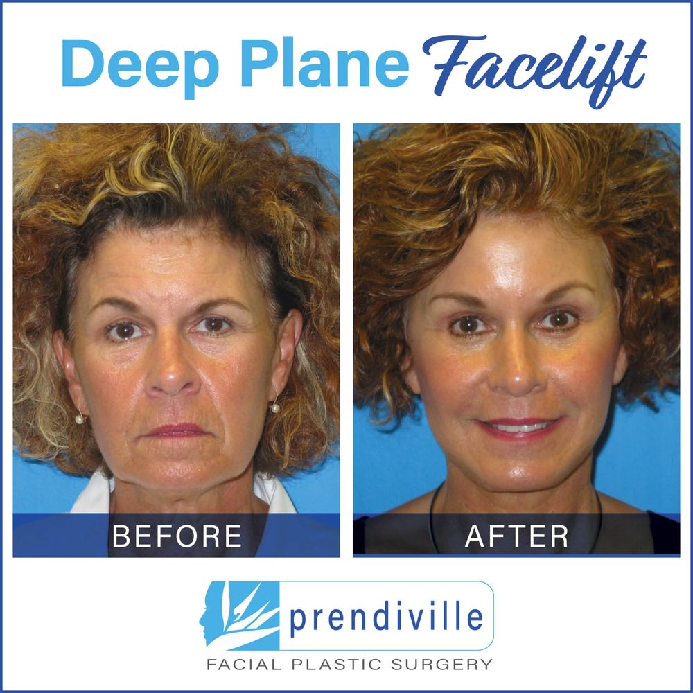 PRENDIVILLE FACIAL PLASTIC SURGERY - Updated June 2024 - 9407 Cypress ...
