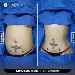 Vixen Plastic Surgery Photos