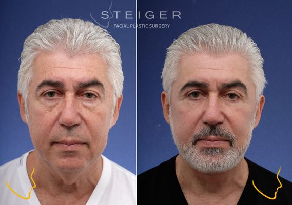 STEIGER FACIAL PLASTIC SURGERY: DR. JACOB D. STEIGER - Updated December ...
