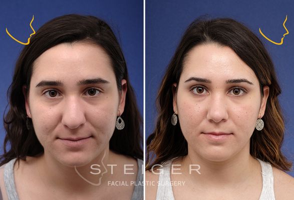 STEIGER FACIAL PLASTIC SURGERY: DR. JACOB D. STEIGER - Updated December ...