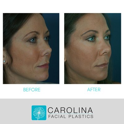CAROLINA FACIAL PLASTICS - Updated November 2024 - 373 Photos & 34 ...