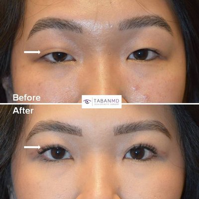 MEHRYAR RAY TABAN MD - OCULOPLASTIC SURGEON - Updated December 2025 ...