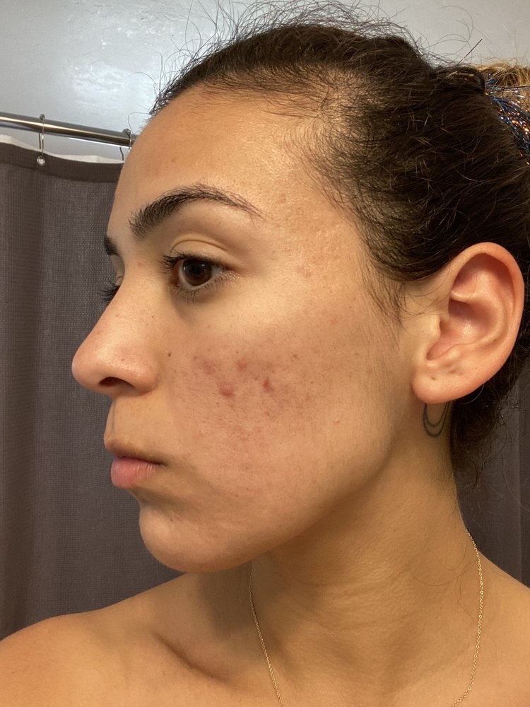 PRODERMA ACNE TREATMENT SYSTEMS FOR TEENS - Updated July 2025 - 60 ...