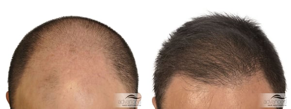 ADVANCED HAIR RESTORATION - Updated April 2024 - 36 Photos & 23 Reviews ...