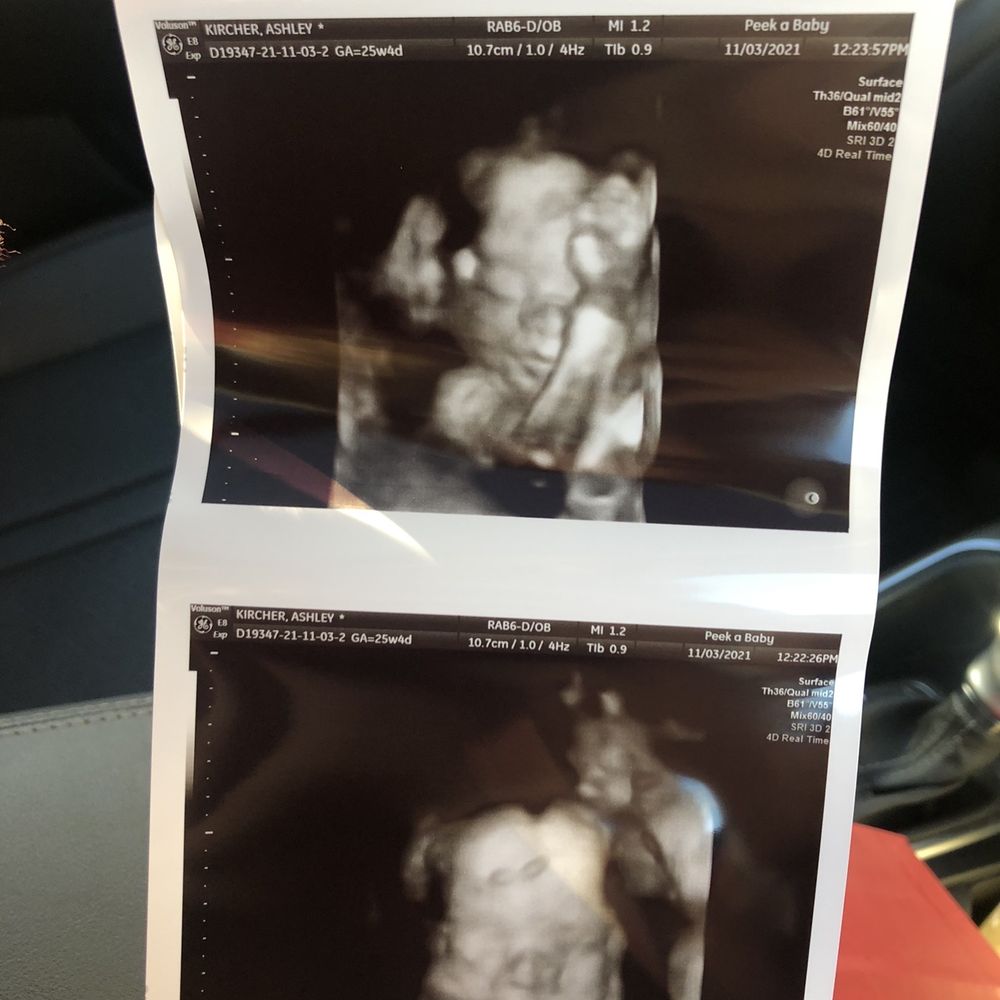 25 Weeks Pregnant 3d Ultrasound