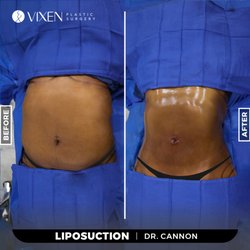 Vixen Plastic Surgery Photos